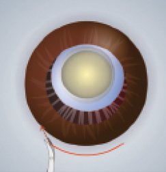Comparative study of effect of temporal versus superior incision in ...